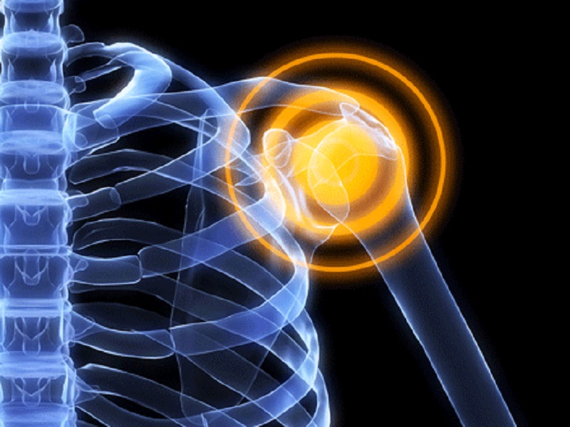 Spondilite anchilosante: tofacitinib rimborsato in Italia - Corriere ...