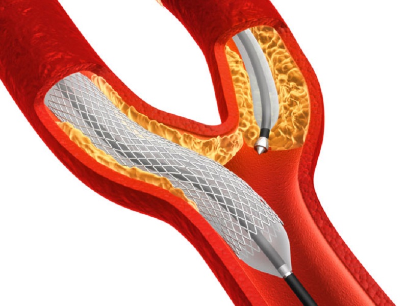 Impianto di stent: doppia terapia antipiastrinica la migliore ...